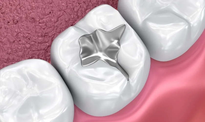 Pediatric Dental Fillings In Corinth, TX - Adorable Smiles Pediatric ...